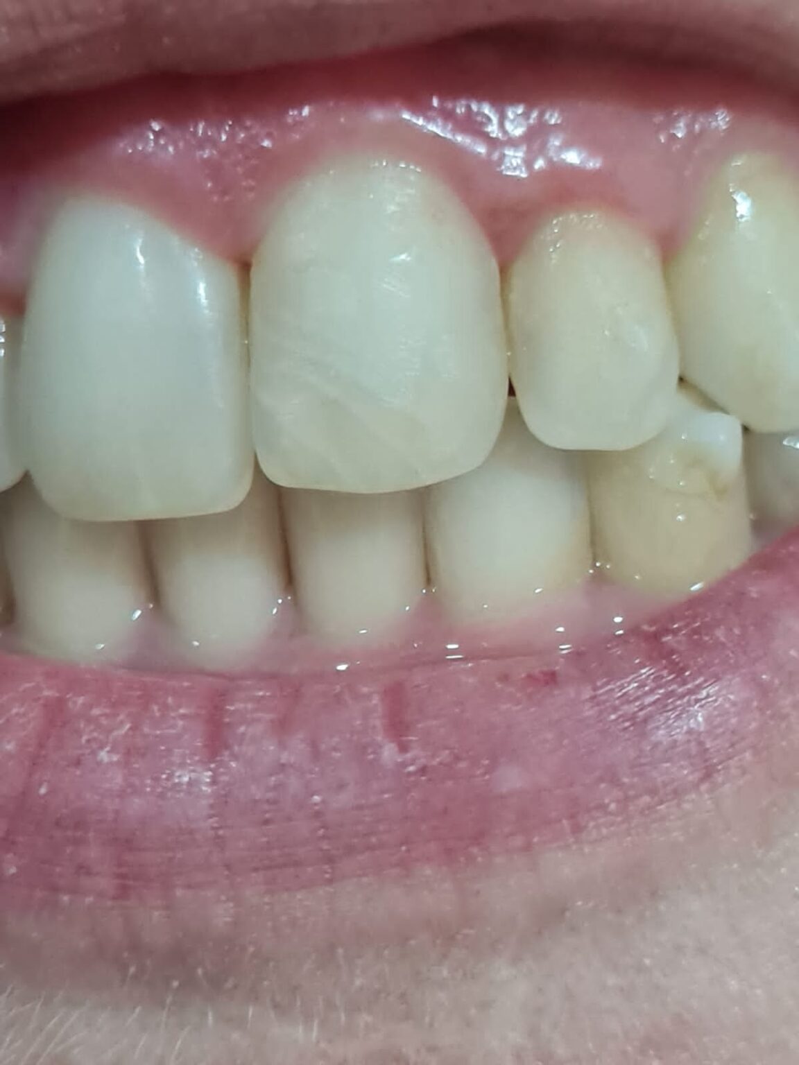 Você já ouviu falar na Síndrome do Dente Rachado? - Bio Odontológica